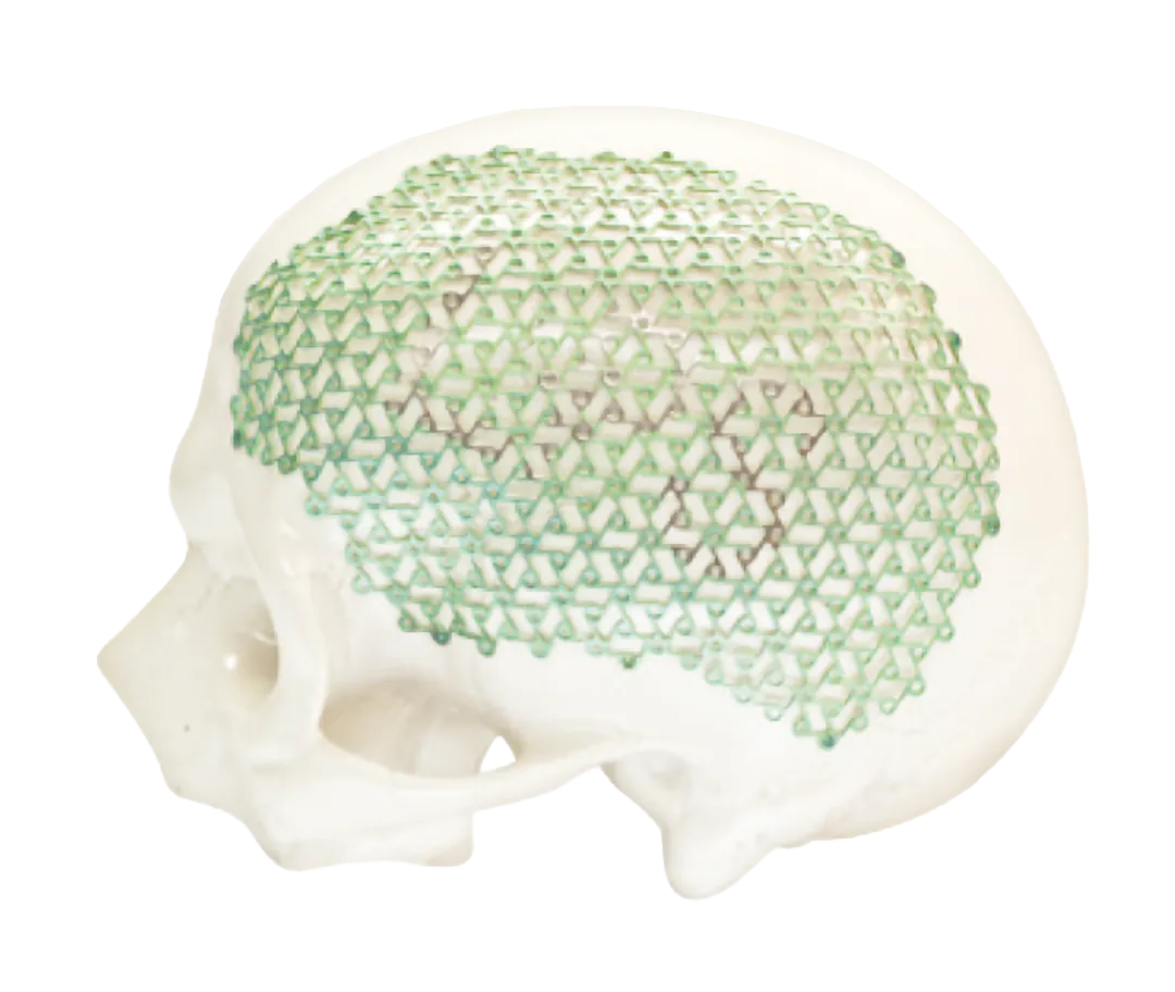 Craneoplastía - Soluciones en titanio para defectos craneales